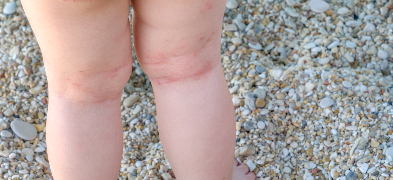 Eczema in children: uncertainties addressed